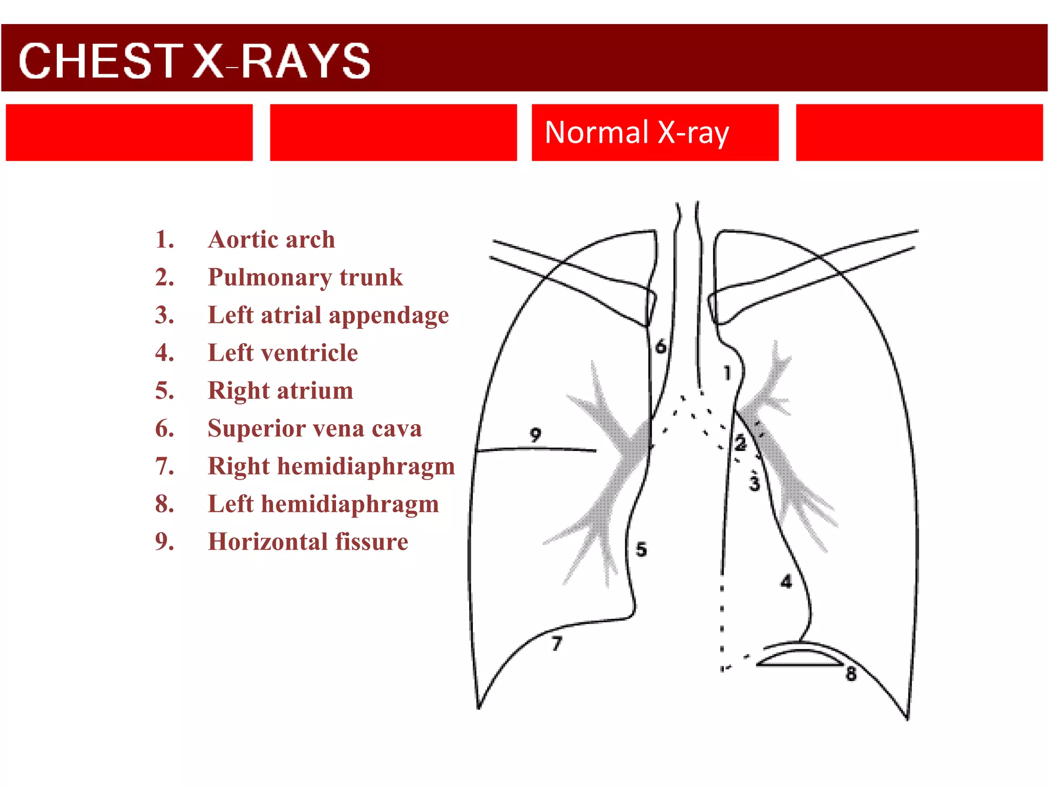 1 Chest X rays.pptx