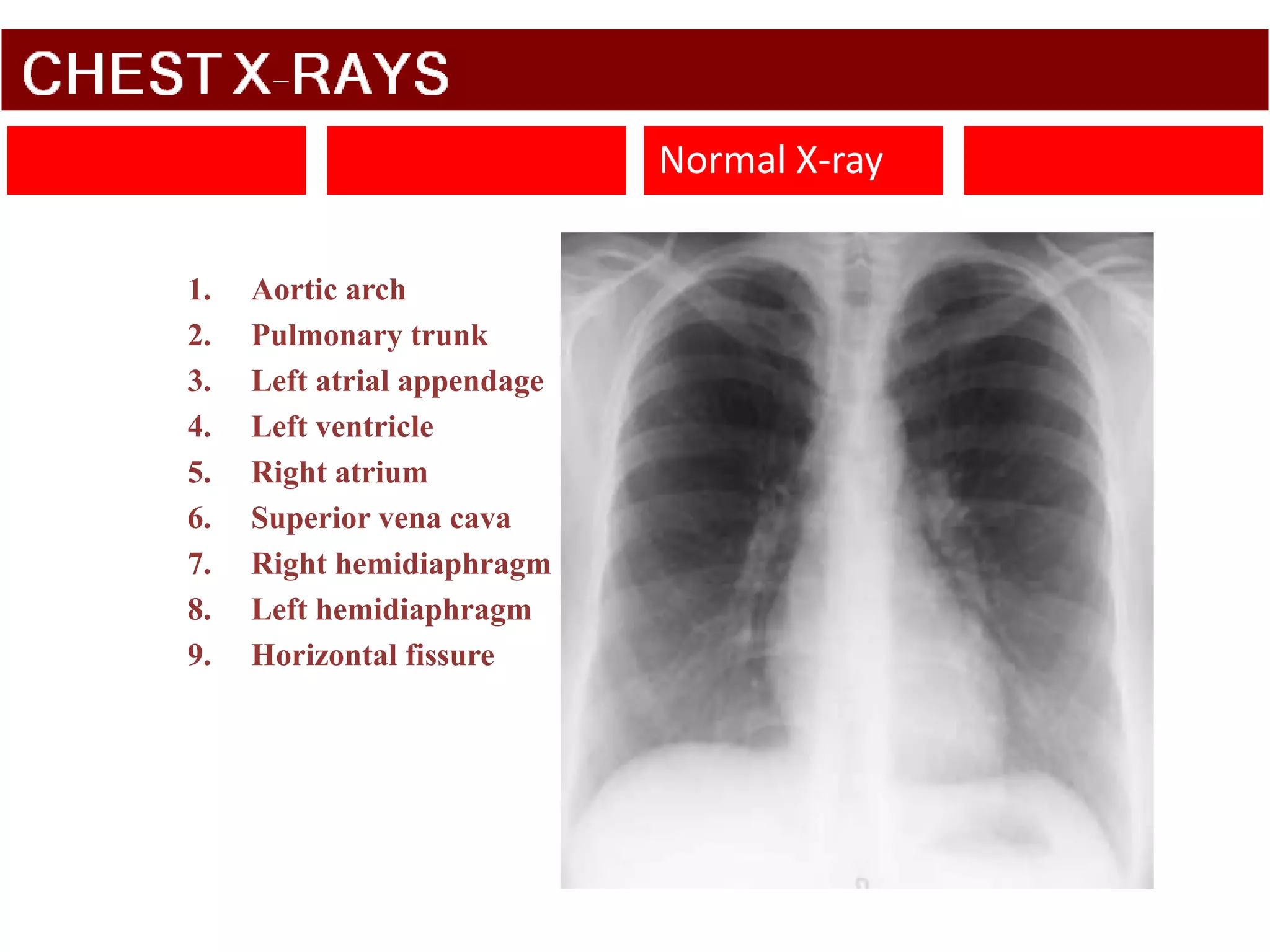 1 Chest X rays.pptx
