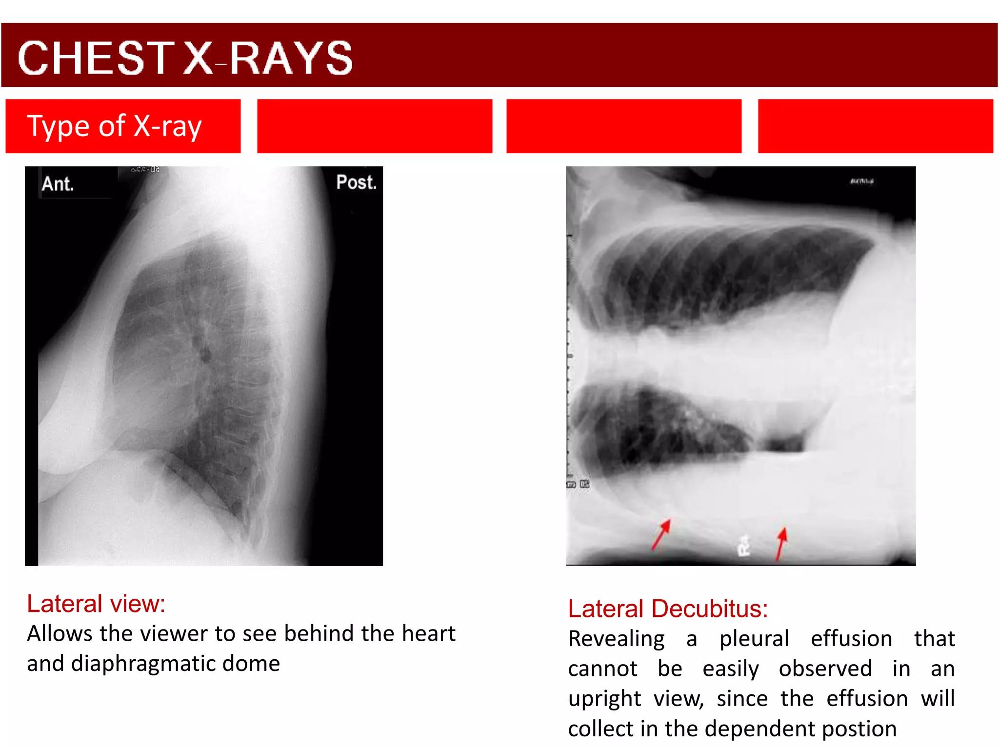 1 Chest X rays.pptx