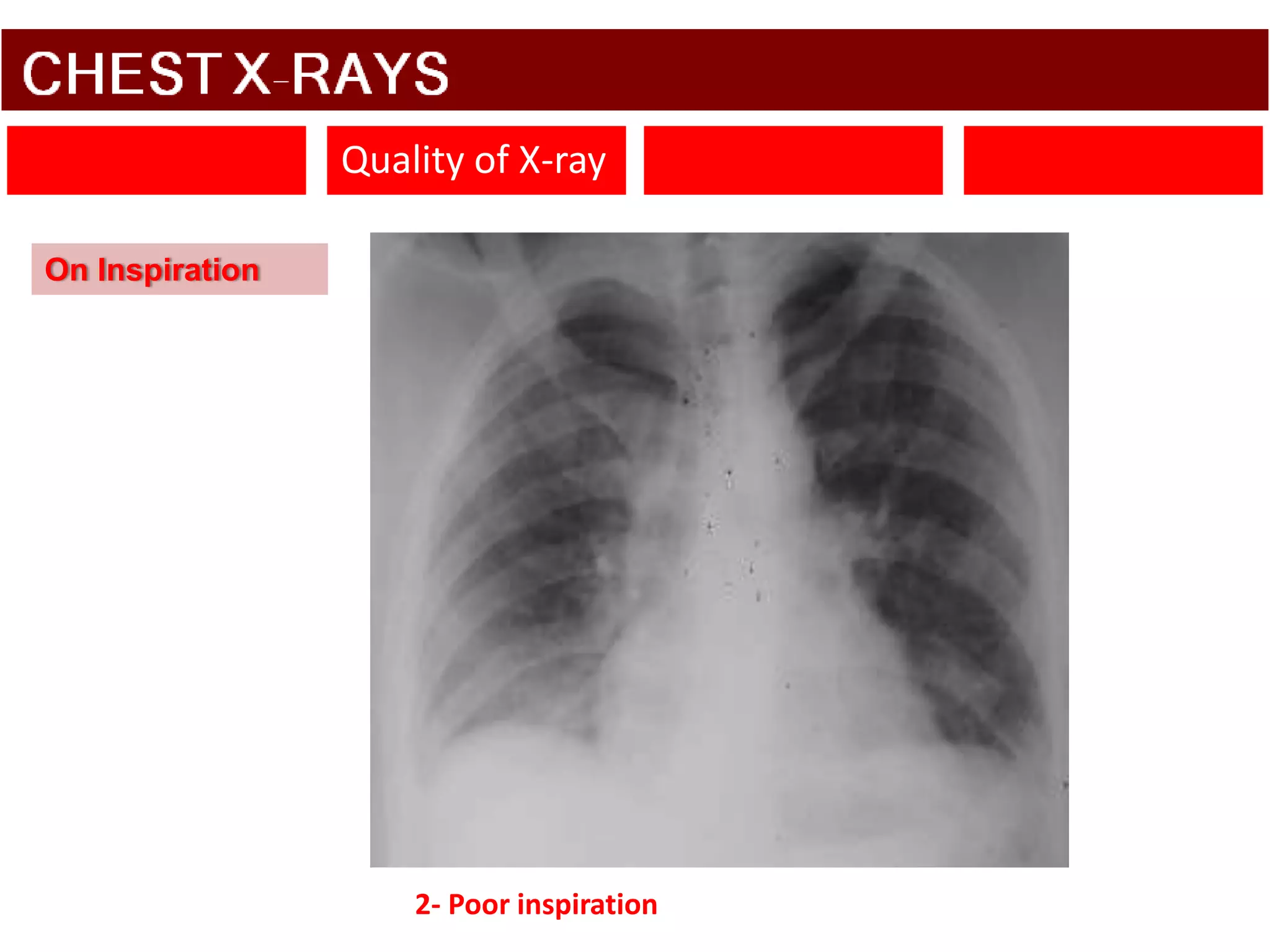 1 Chest X rays.pptx