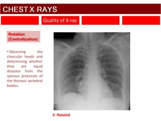 1 Chest X rays.pptx