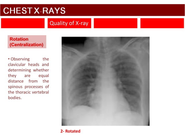 1 Chest X rays.pptx