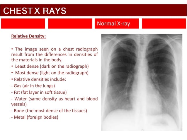 1 Chest X rays.pptx