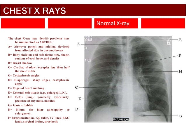 1 Chest X rays.pptx