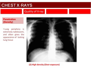 1 Chest X rays.pptx