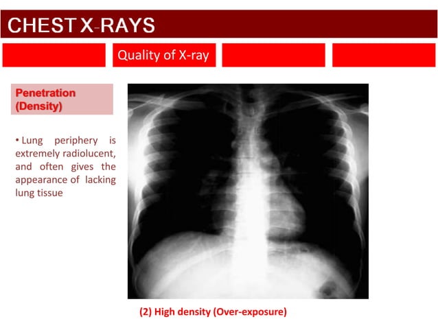 1 Chest X rays.pptx