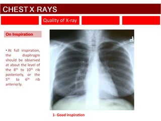 1 Chest X rays.pptx