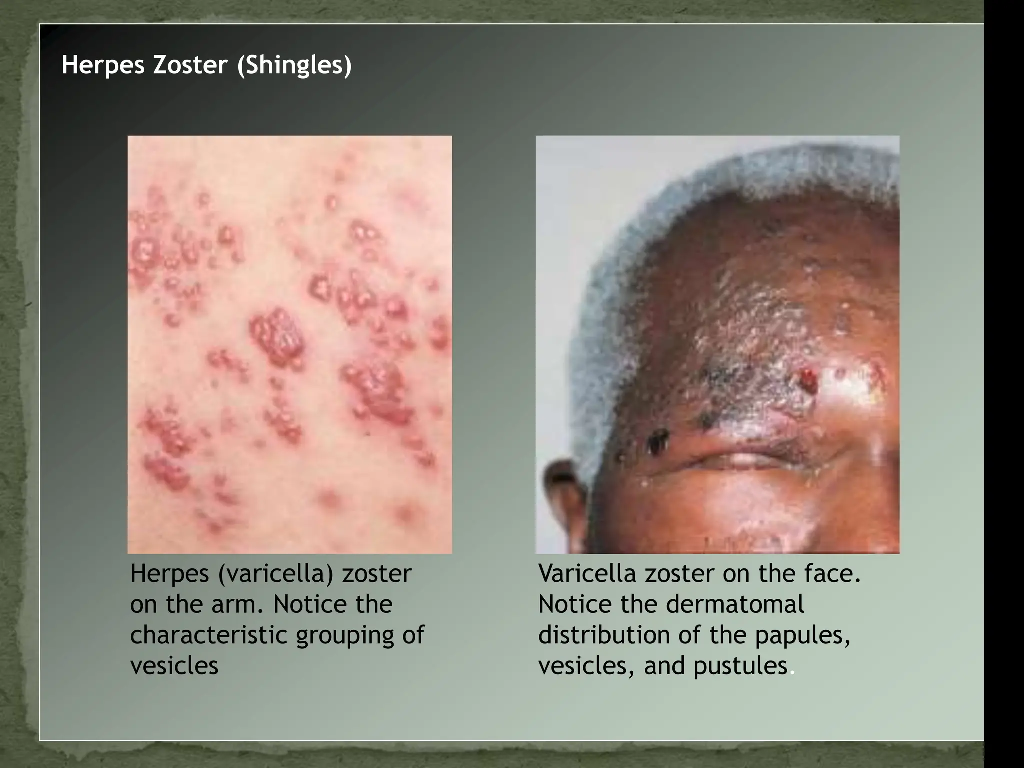 Prevention and control of Chickenpox.pptx