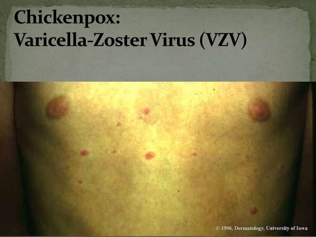 Prevention and control of Chickenpox.pptx