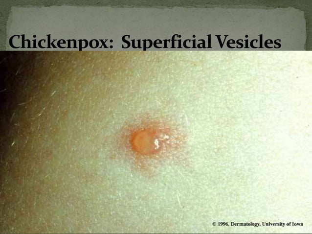Prevention and control of Chickenpox.pptx