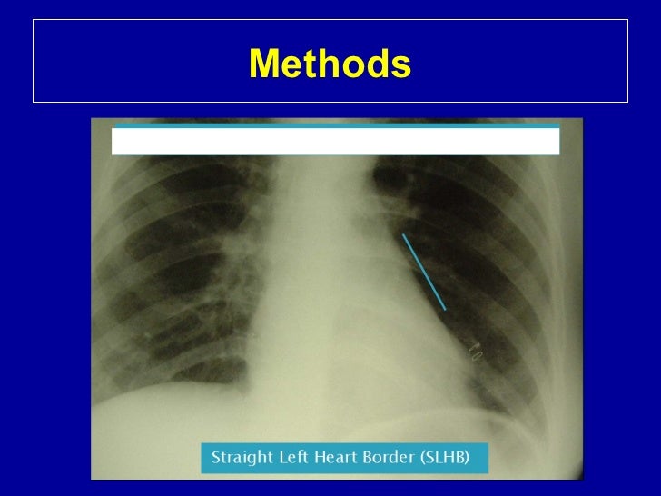Straight Left Heart Border-Dr. Sharfuddin Chowdhury