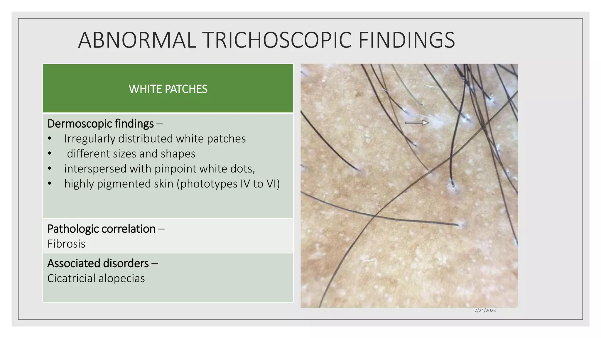 Trichoscopy of cicatricial alopecia.pptx