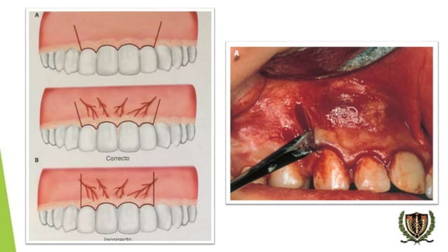 Colgajos de Cavidad Bucal