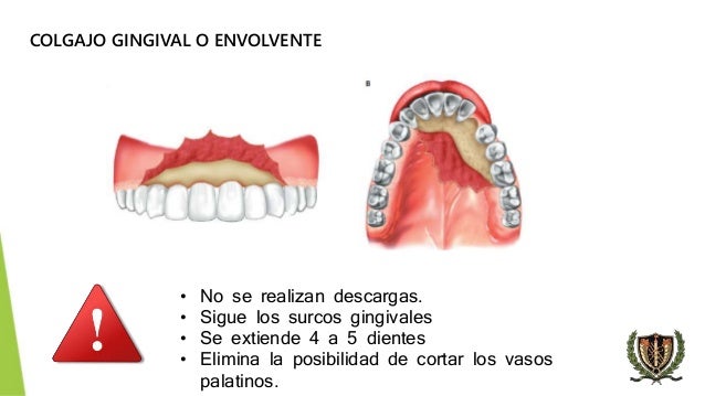 Colgajos de Cavidad Bucal