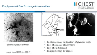 1_COPD_Part_1_Definition,_Epidemiology_and_Pathophysiology.pdf