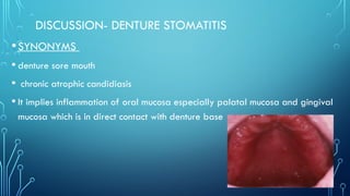 1 DENTURE STOMATITIS.pptxftyftyytfytftfty | PPT