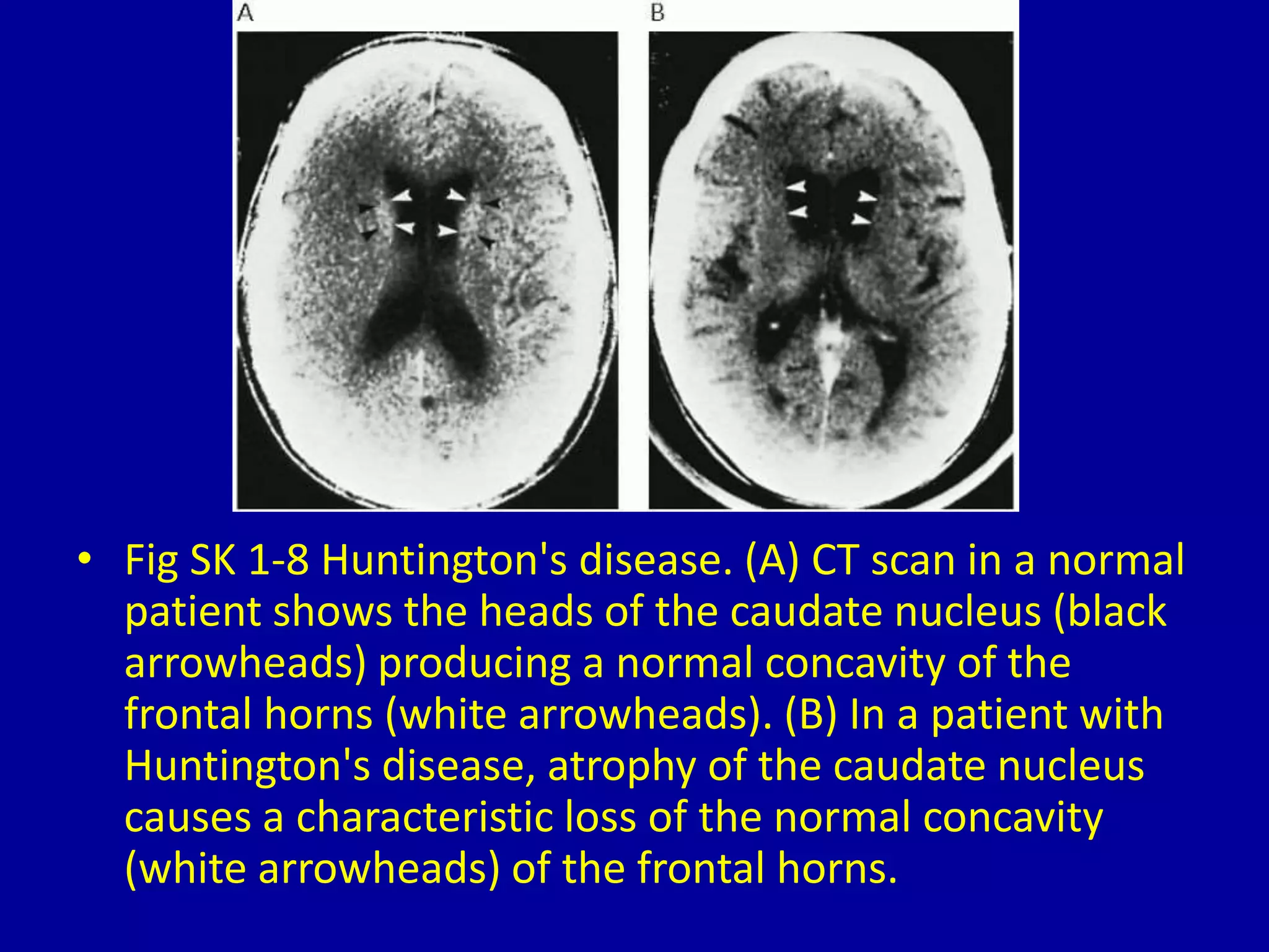 1 dilated cerebral ventricles Radiology | PPTX