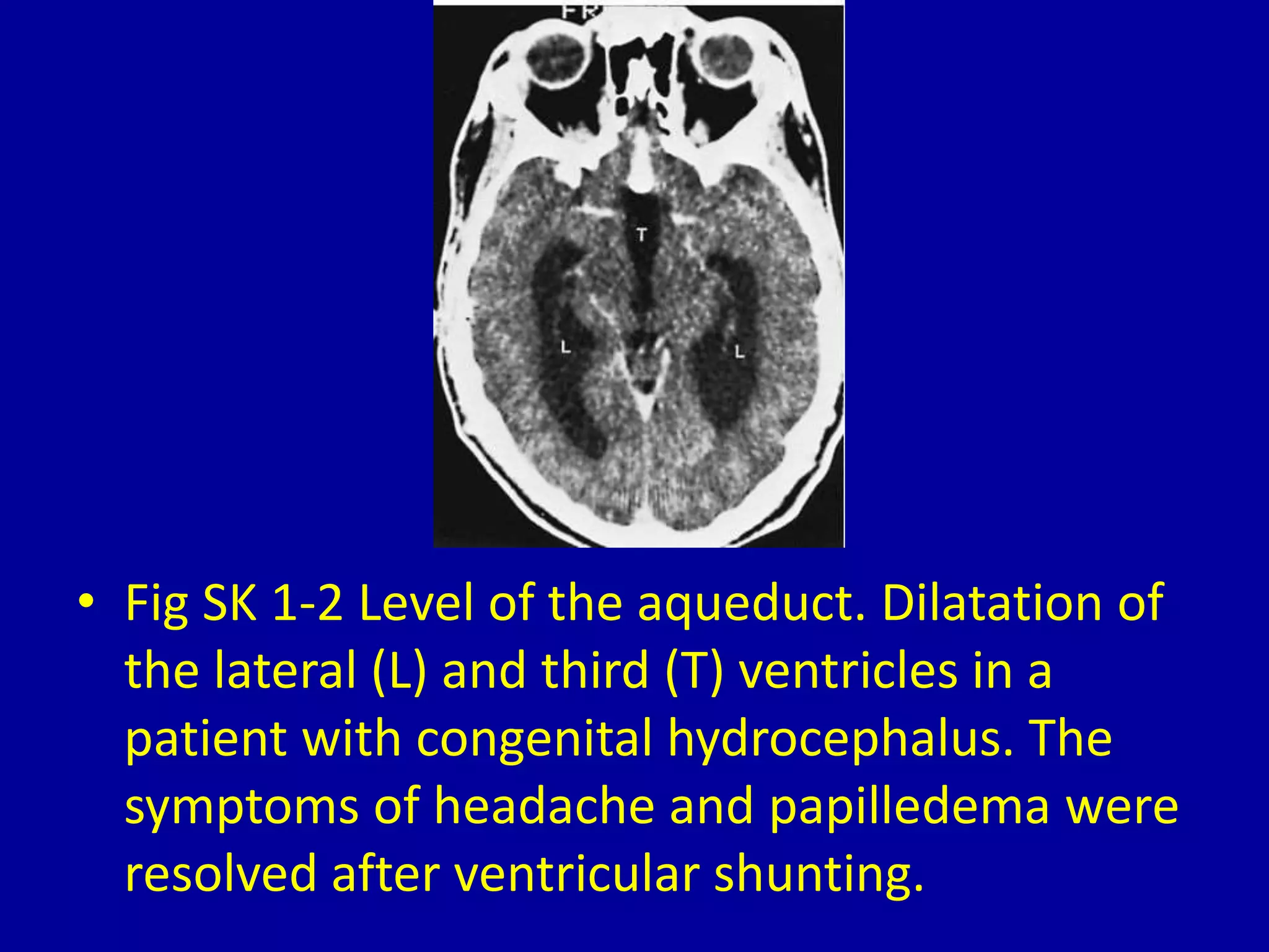 1 dilated cerebral ventricles Radiology | PPTX