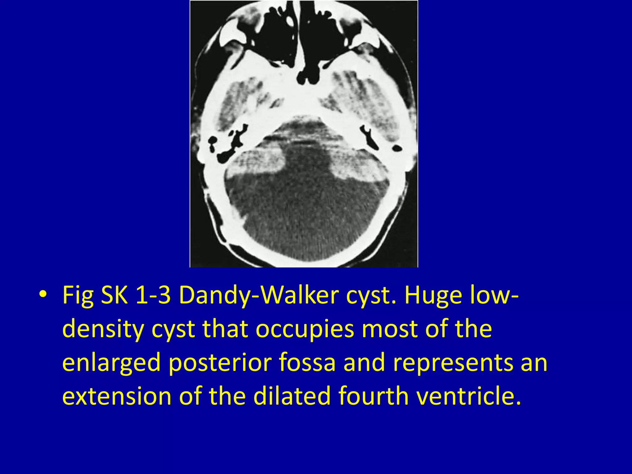 1 dilated cerebral ventricles Radiology | PPTX