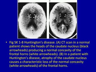 1 dilated cerebral ventricles Radiology | PPTX