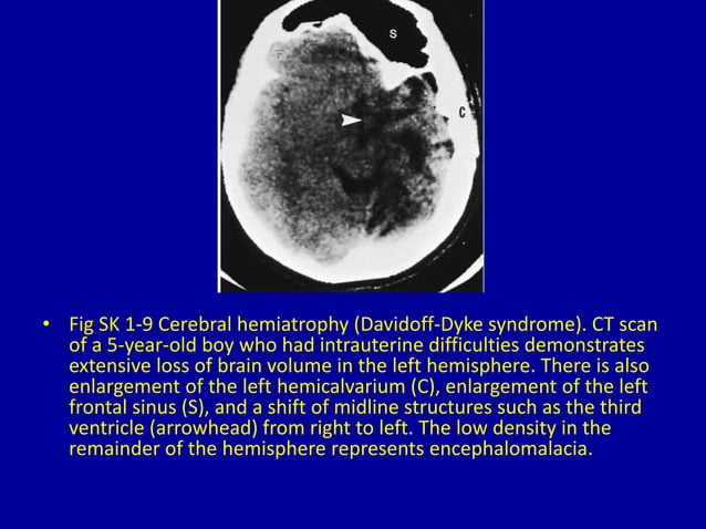 1 dilated cerebral ventricles Radiology | PPT