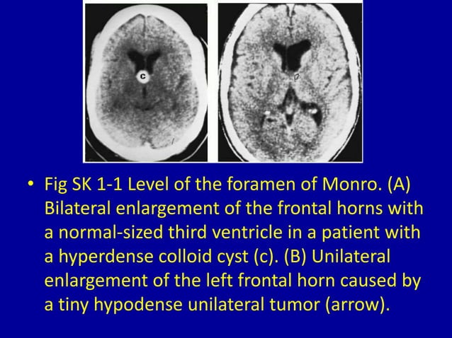 1 dilated cerebral ventricles Radiology | PPT