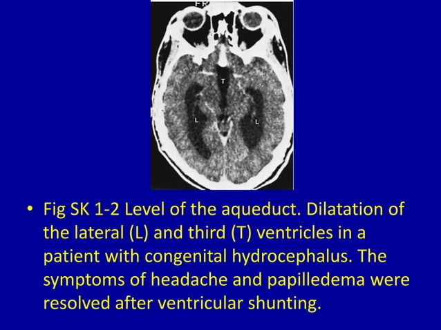 1 dilated cerebral ventricles Radiology | PPT