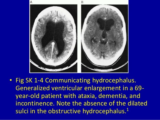 1 dilated cerebral ventricles Radiology
