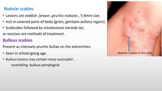 Nodular Scabies