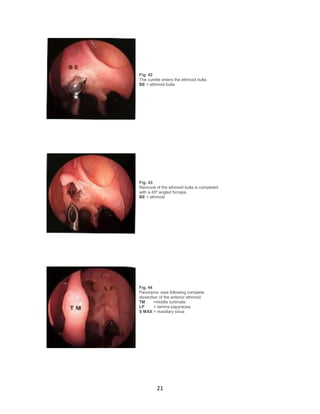 DISECCION ENDOSCOPICA EN CADAVER DE NARIZ Y SENOS PARANASALES.docx
