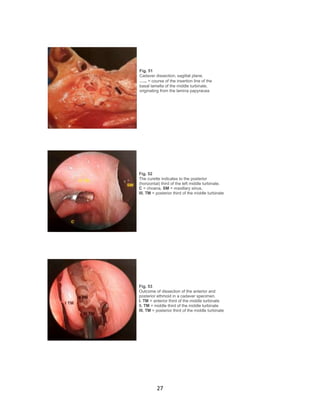 DISECCION ENDOSCOPICA EN CADAVER DE NARIZ Y SENOS PARANASALES.docx