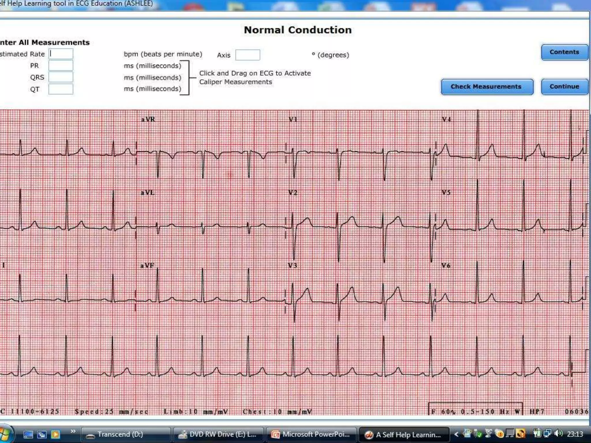 normal-electrocardiogram | PPTX