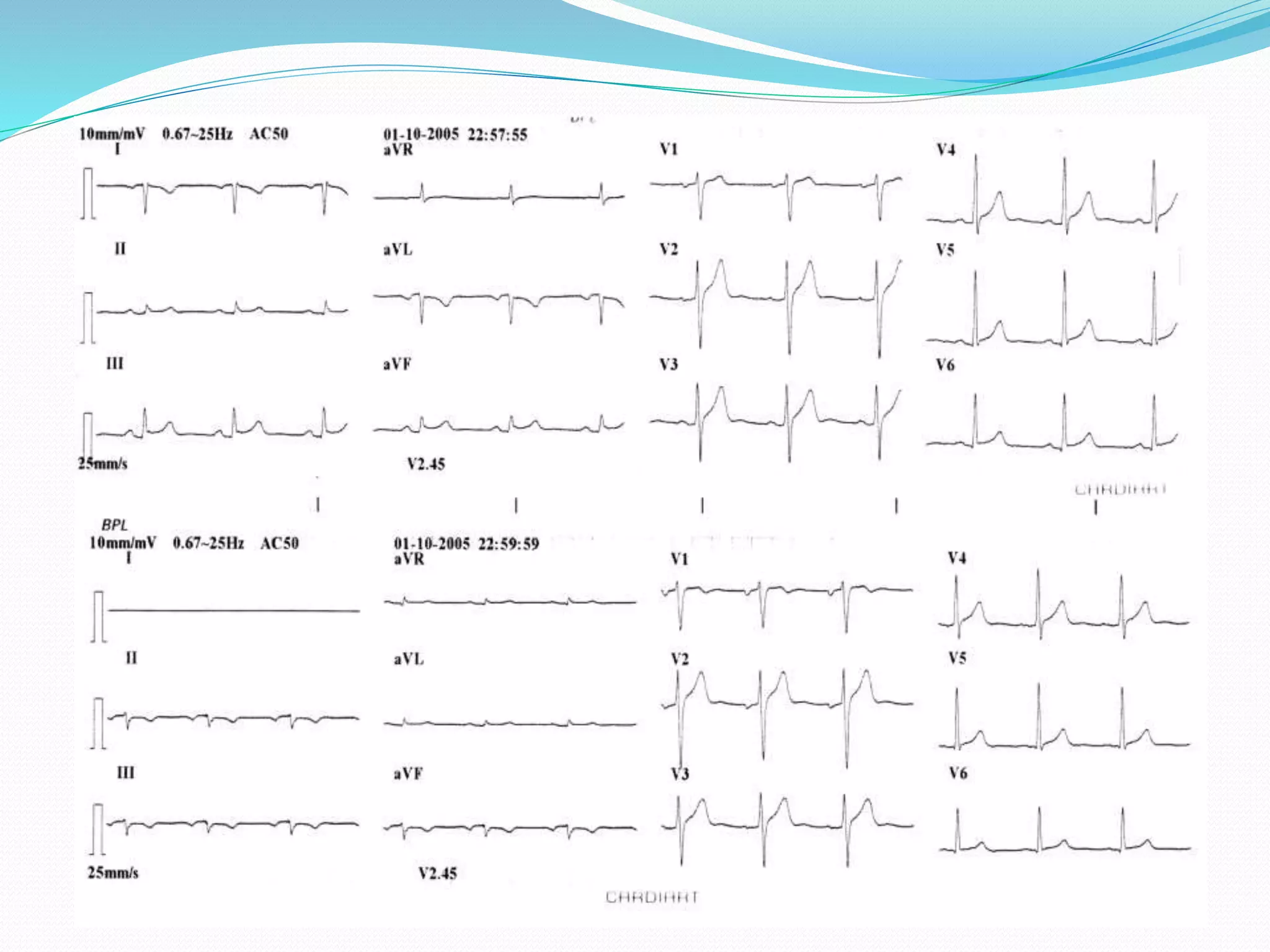 normal-electrocardiogram | PPTX