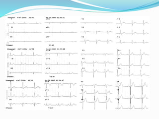 normal-electrocardiogram | PPTX