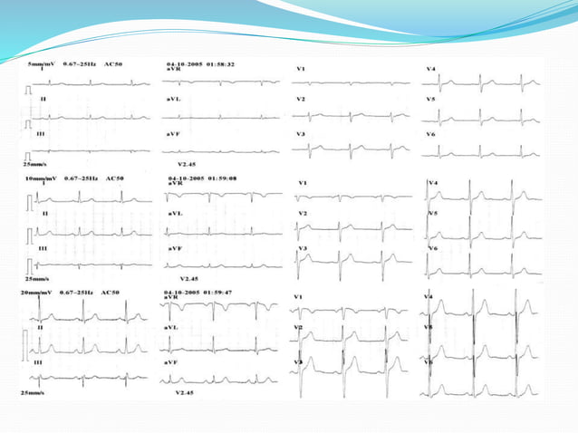 normal-electrocardiogram | PPTX | Heart and Cardiovascular Diseases | Diseases and Conditions