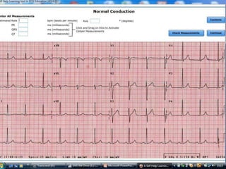 normal-electrocardiogram | PPTX