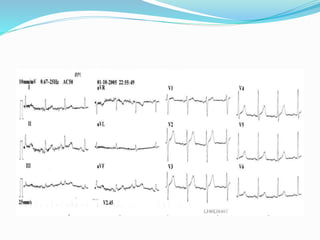 normal-electrocardiogram | PPTX