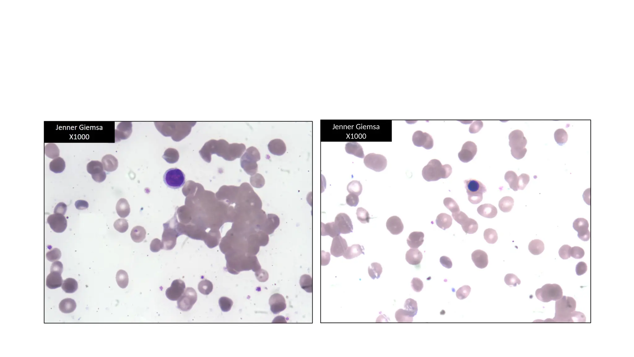 1_Dr Jasmita Das Peripheral blood smear examination with Romanowsky ...