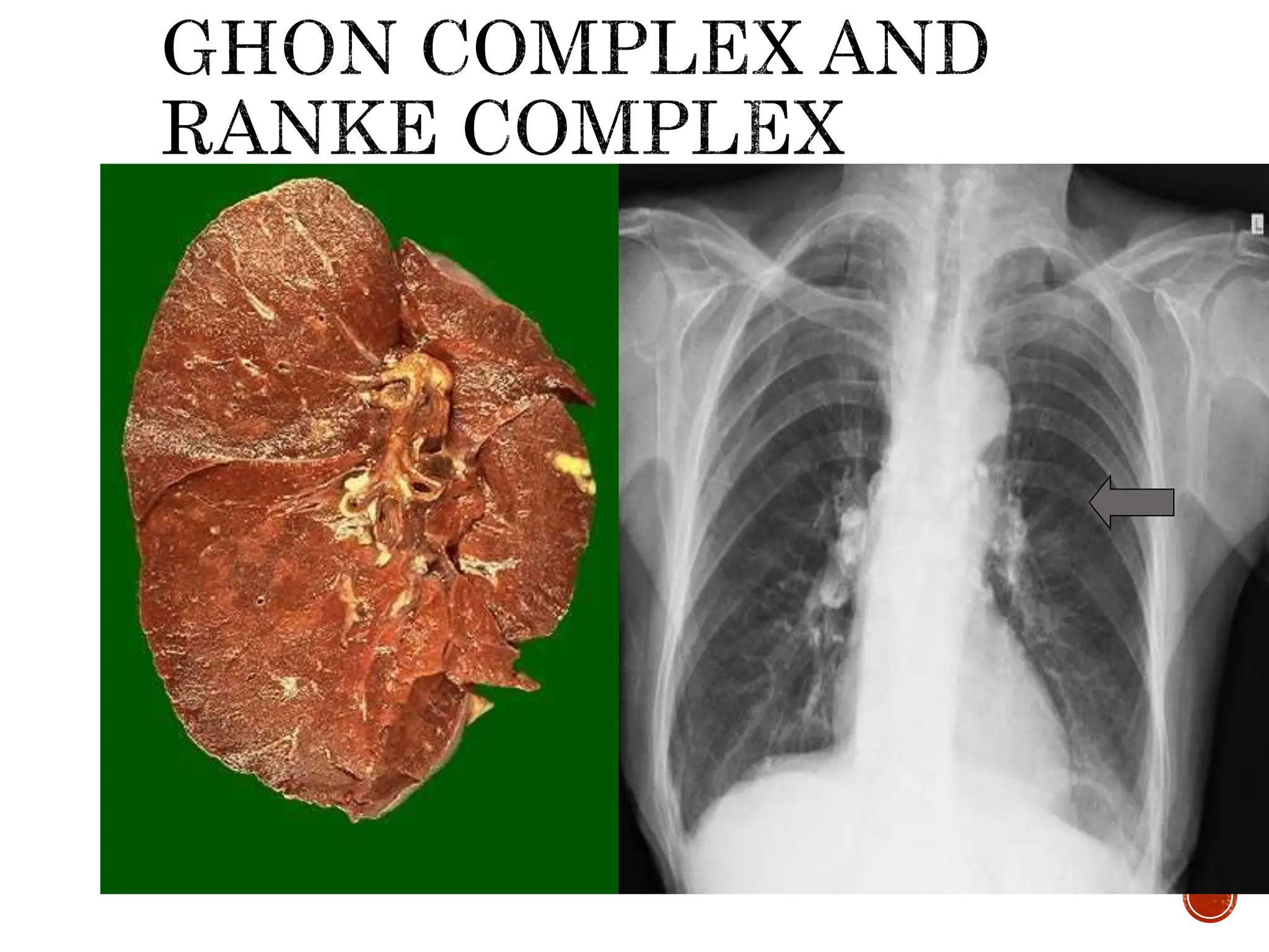 Pathophysiology of Tuberculosis and it's Complications | PPTX