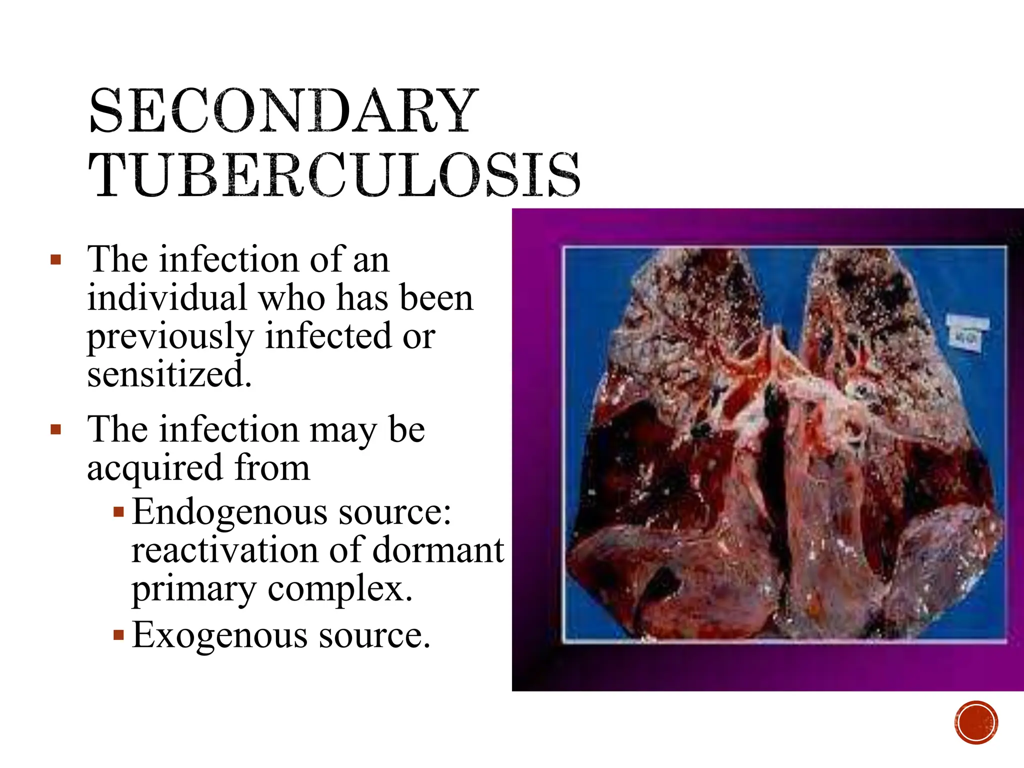 Pathophysiology of Tuberculosis and it's Complications | PPTX