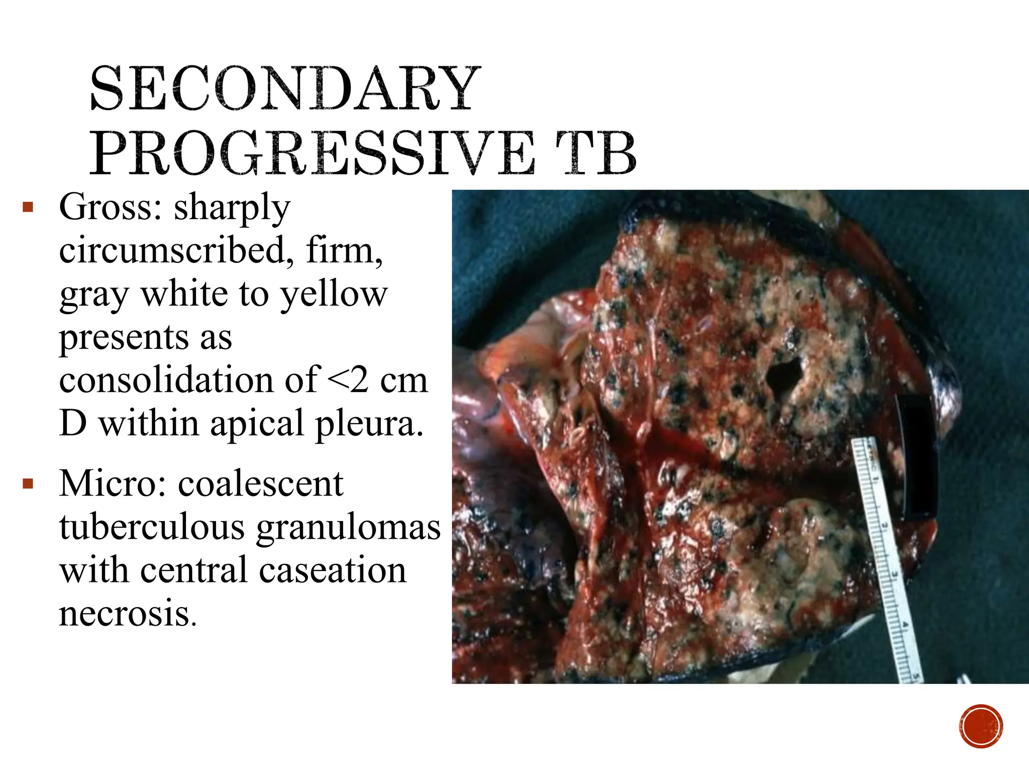 Pathophysiology of Tuberculosis and it's Complications | PPTX