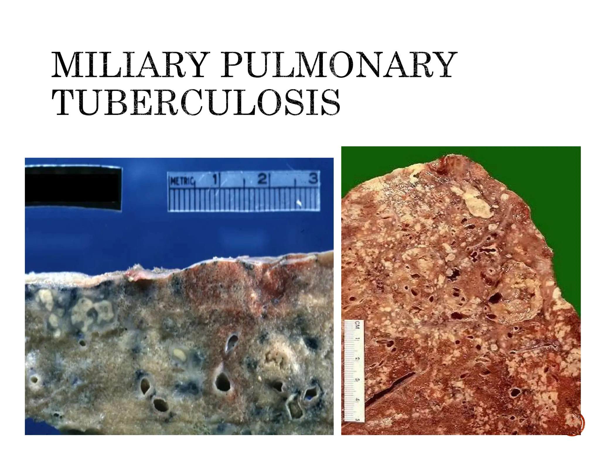 Pathophysiology of Tuberculosis and it's Complications | PPTX