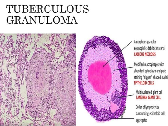 Pathophysiology of Tuberculosis and it's Complications | PPTX ...
