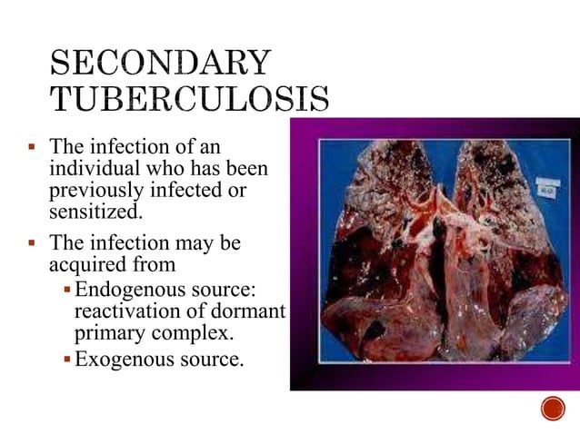 Pathophysiology of Tuberculosis and it's Complications | PPTX ...