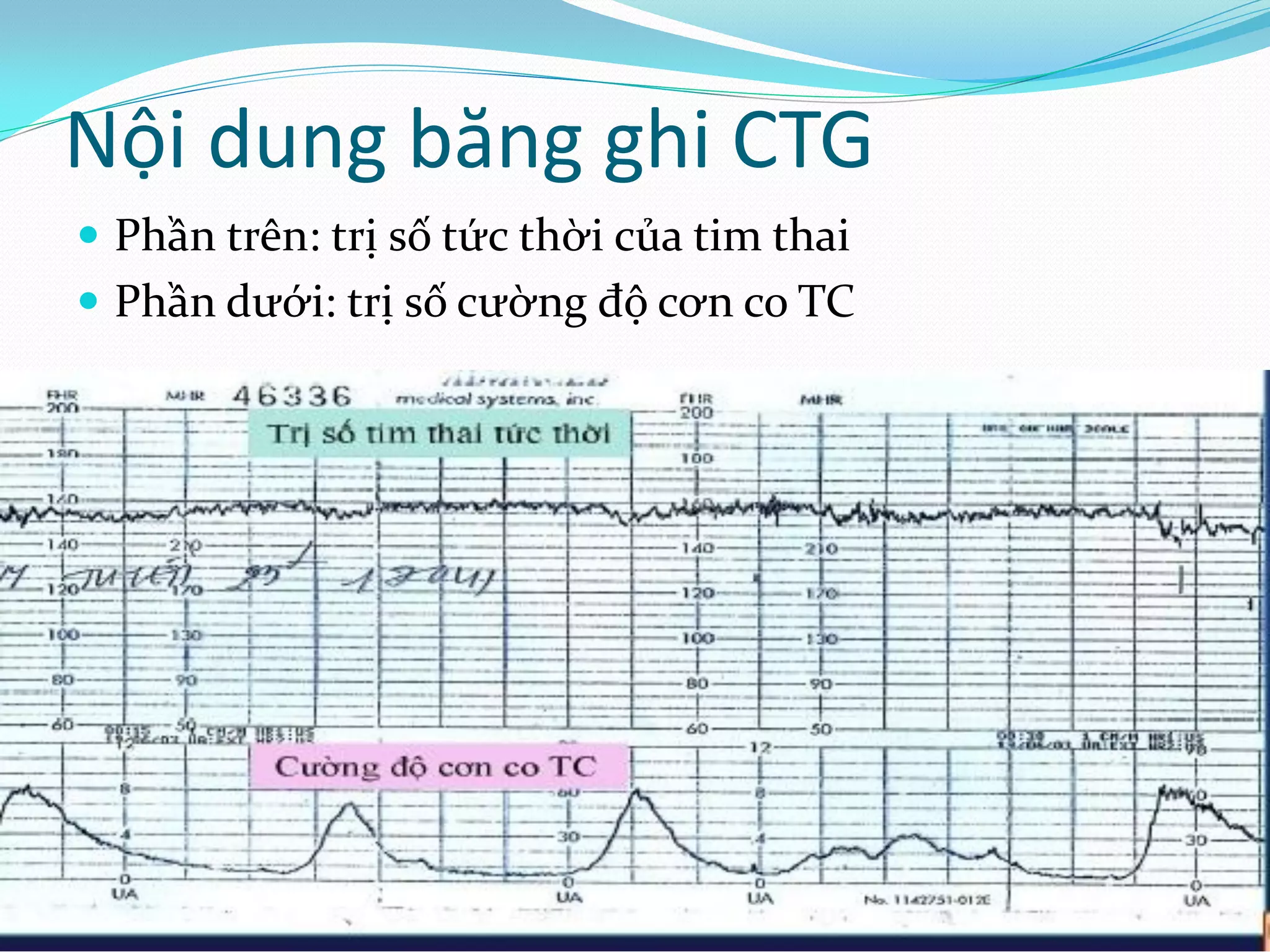 CTG ( EFM ) | PDF