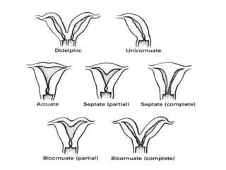 EMBRYOLOGY AND CONGENITAL ANOMALIES OF FEMALE GENITAL TRACT | PPTX