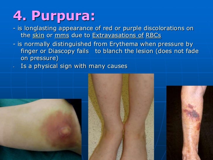 Ecchymosis Vs Bruise