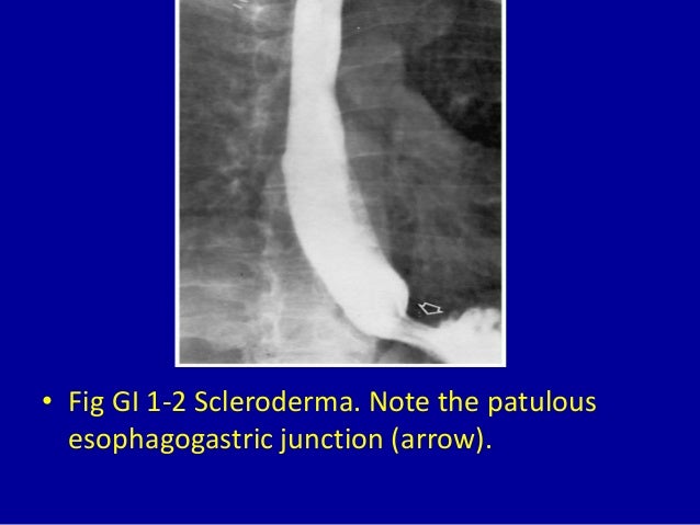 1 esophageal motility disorders