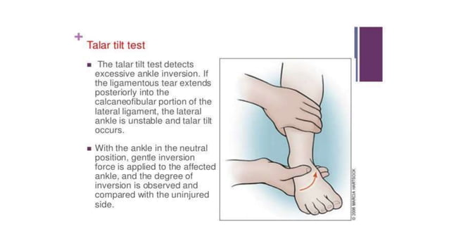 1 Evaluating for Syndesmotic injury.pptx