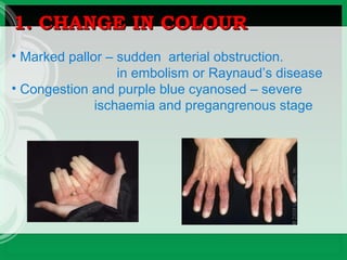 perpheral vascular disease & gangrene examination | PPT